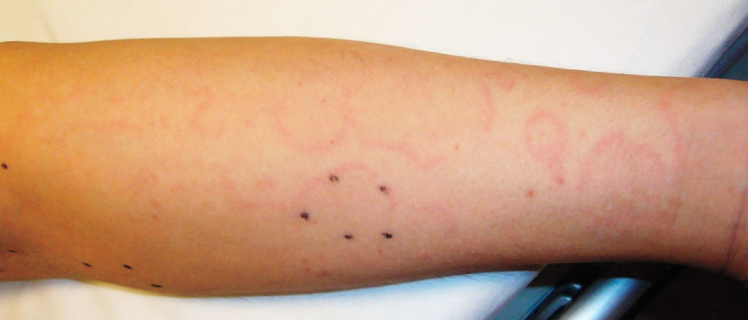 Erythema Marginatum Vs Erythema Multiforme Annular Erythemas And