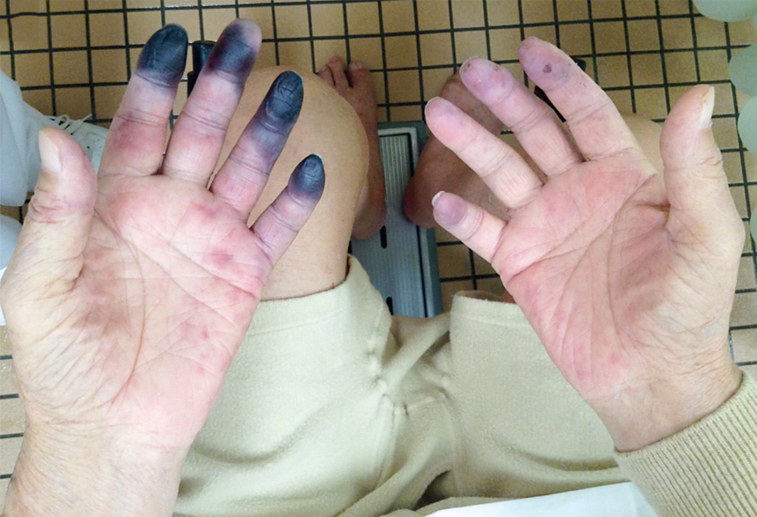 Herpetic Whitlow Palm