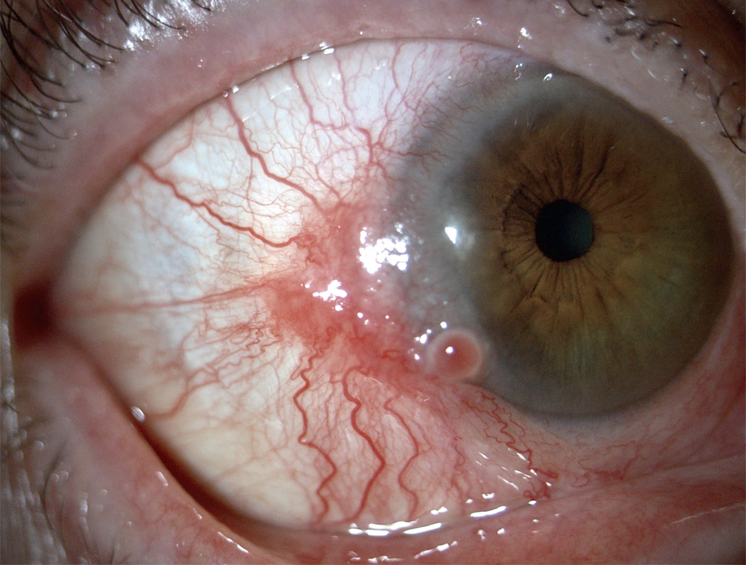 Pyogenic Granuloma Eye Symptoms