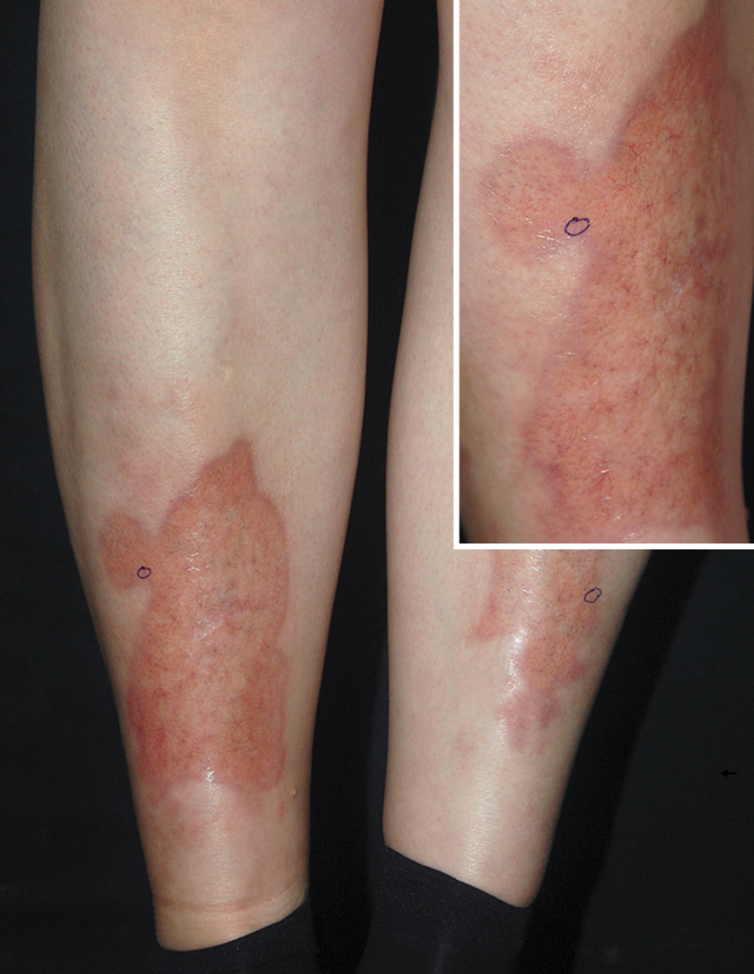 Necrobiosis Lipoidica Diabeticorum Necrobiosis Lipoidica Clinical