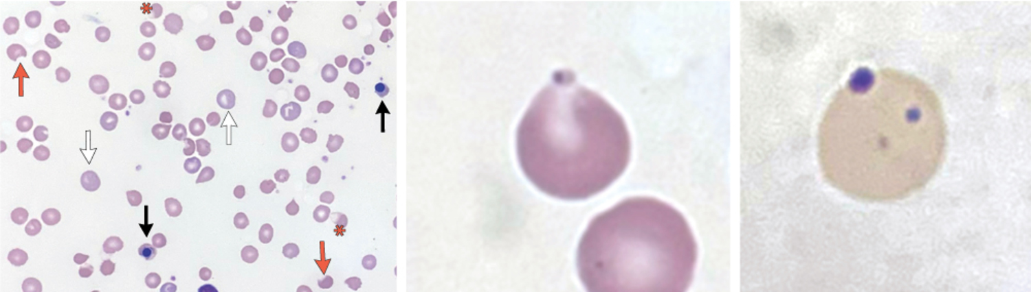 Heinz Bodies And Bite Cells Pathologic RBC Forms Hematology